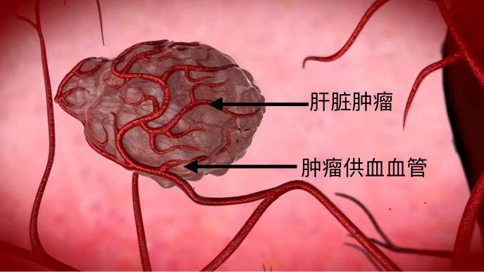 钇[90Y]治疗肝癌，一篇文章看懂它-春雨医生