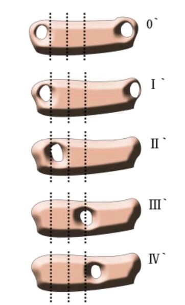 NashMoe法测椎体旋转-春雨医生