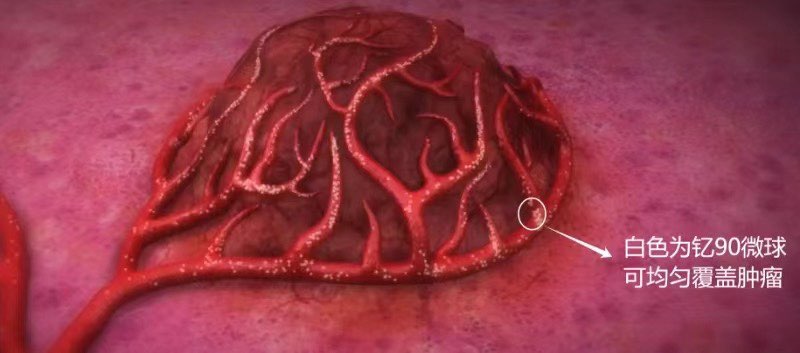 钇[90Y]治疗肝癌，一篇文章看懂它-春雨医生