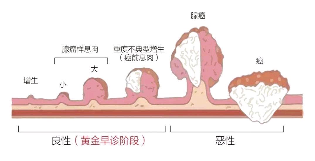 肠息肉癌变的过程 春雨医生