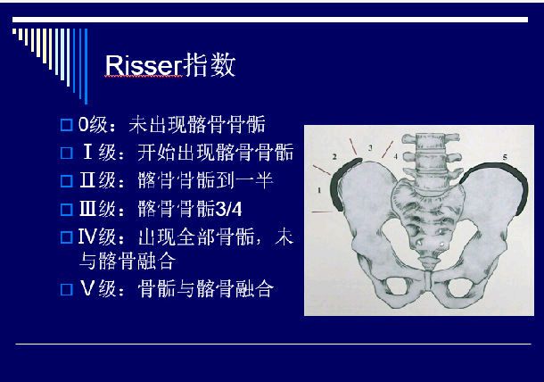 Risser骨骼发育-春雨医生